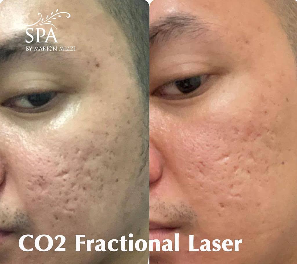 Fractional co2 laser store